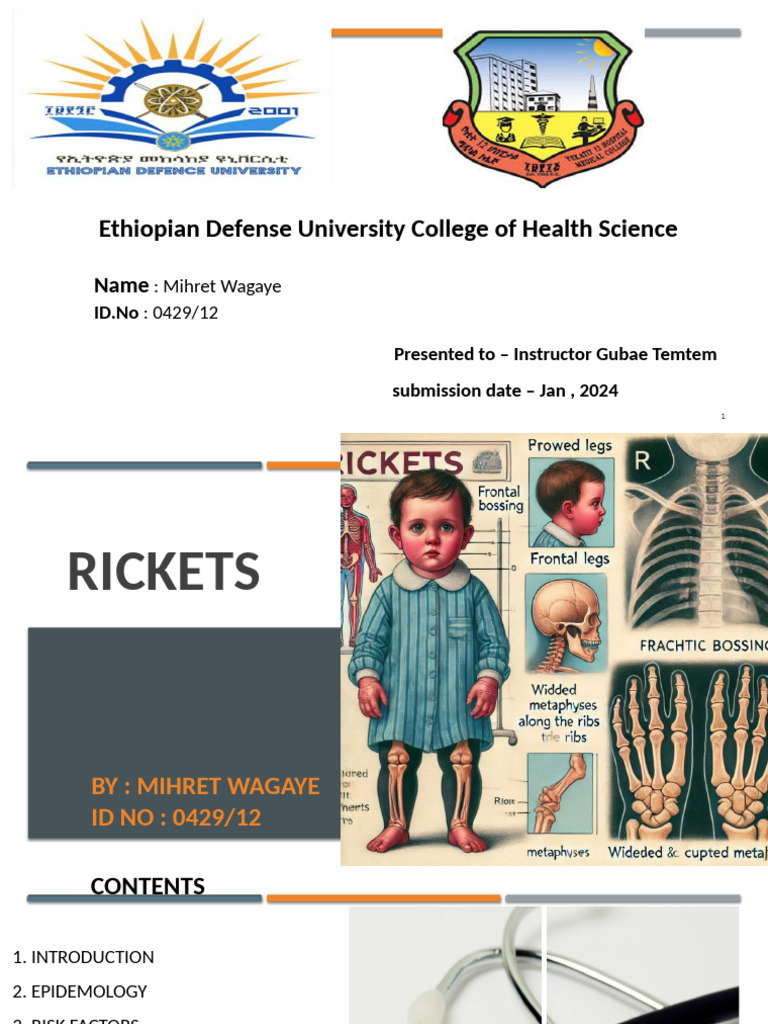 Rickets: Diagnosis and Treatment Overview | PDF | Vitamin D | Vitamin