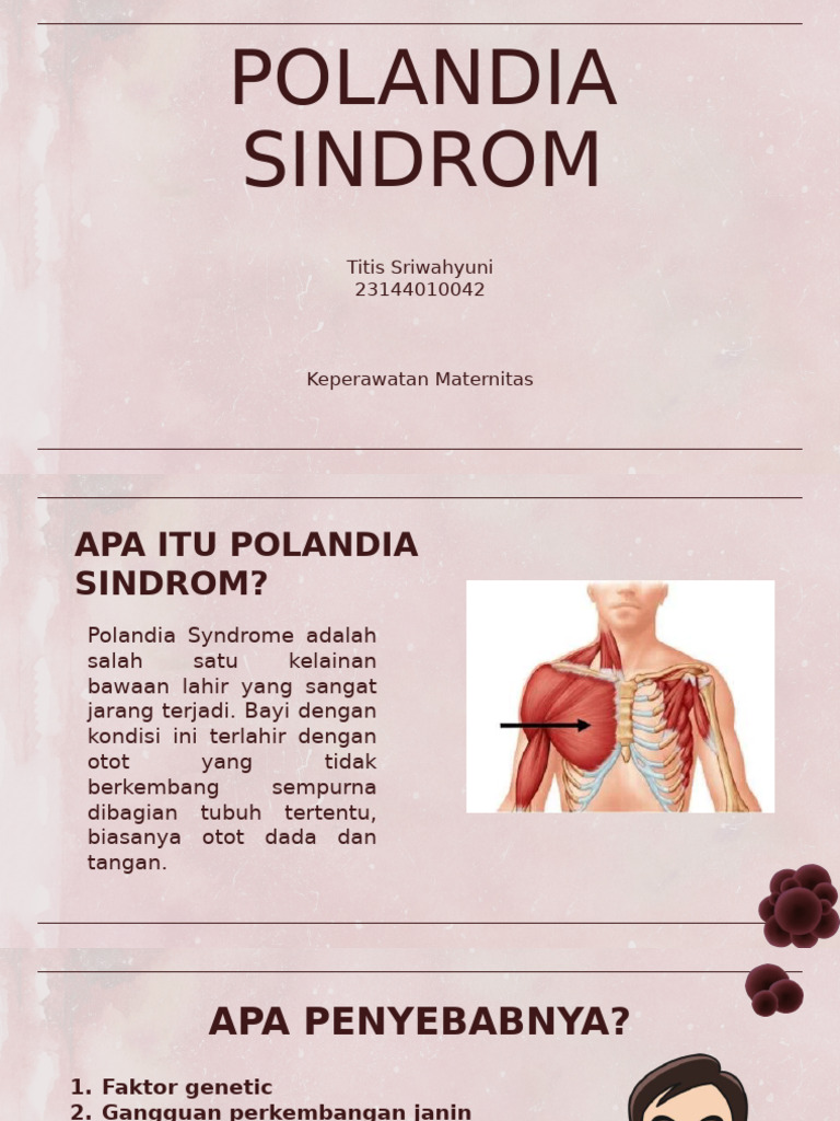 PPT POLANDIA SINDROM | PDF