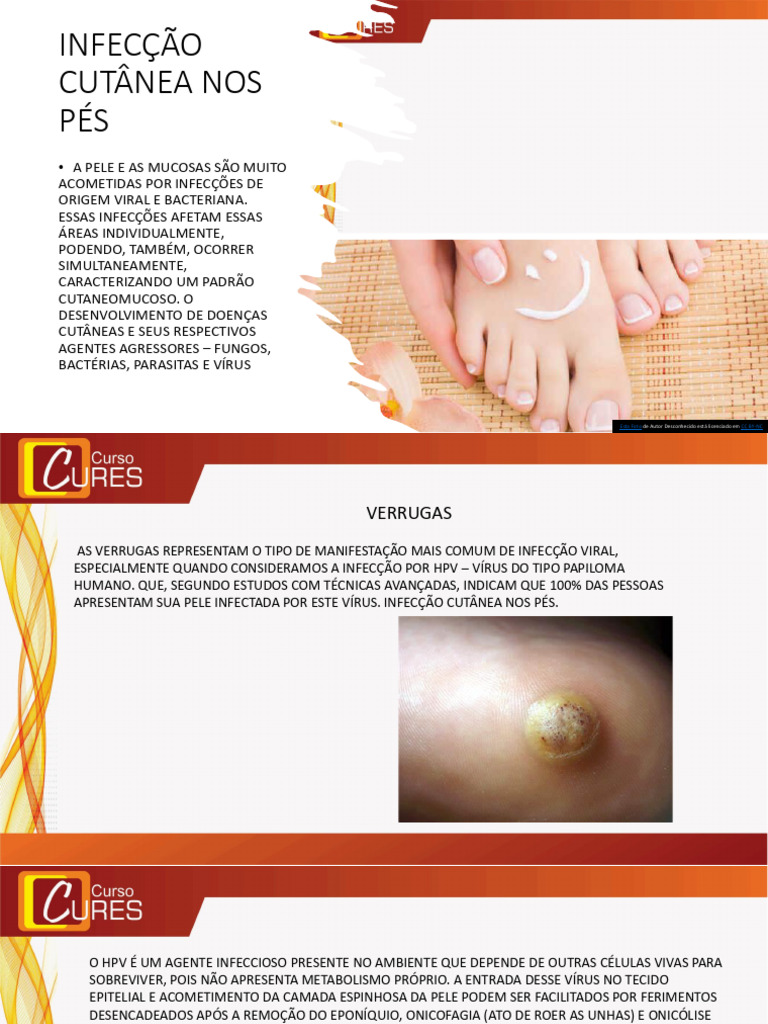 Infecções Cutâneas Comuns nos Pés | PDF | Vírus | Infecção