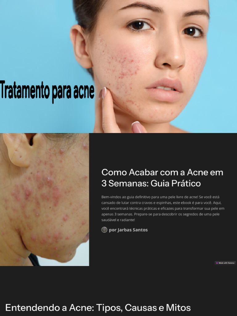 Tratamento para Acne | PDF
