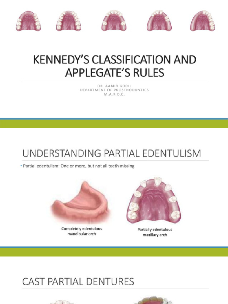 Kennedys Classification in Cast Partial Denture 250970040 | PDF