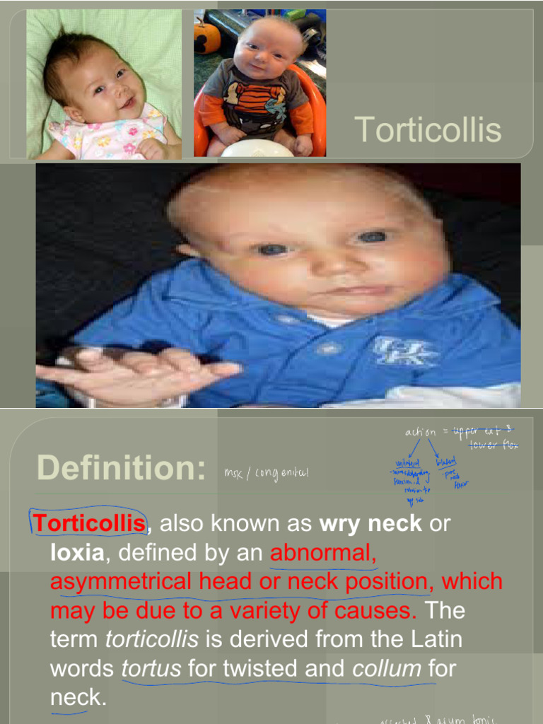 Torticollis | PDF