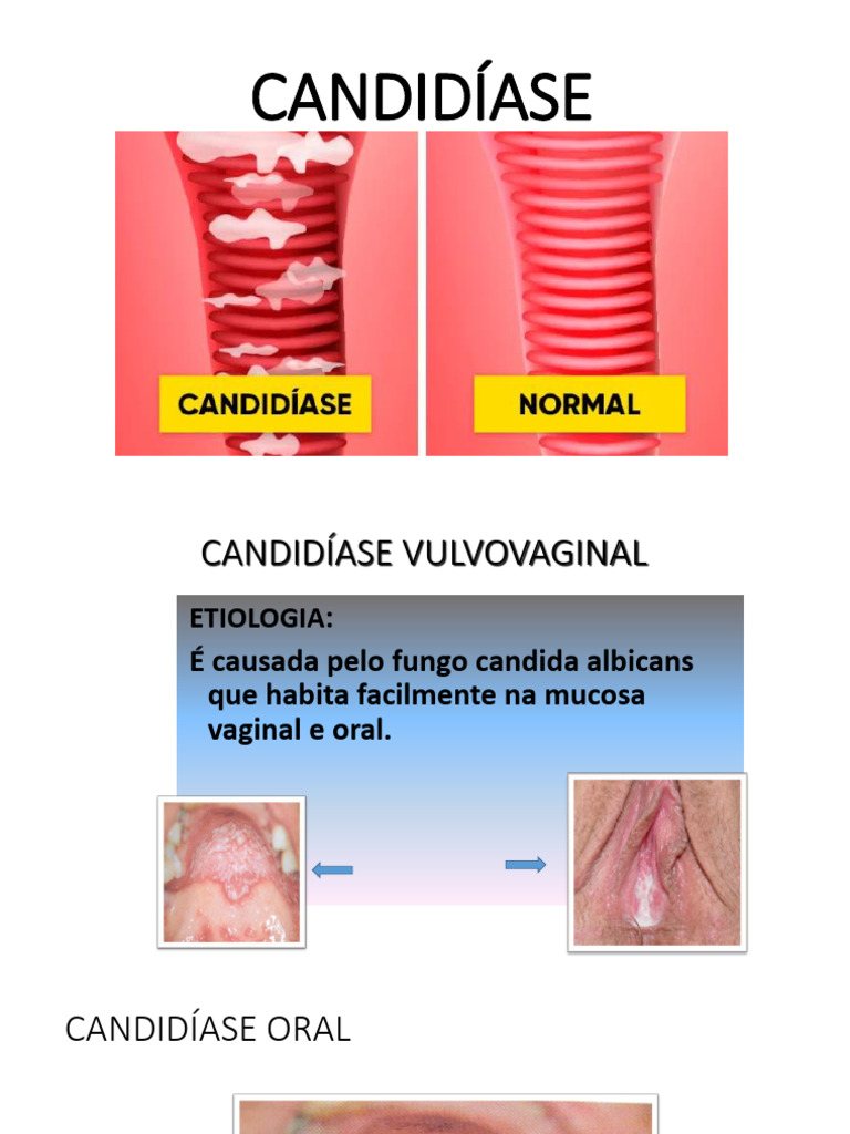 Candidíase: Sintomas e Tratamentos | PDF | Candidíase | Hormônio ...