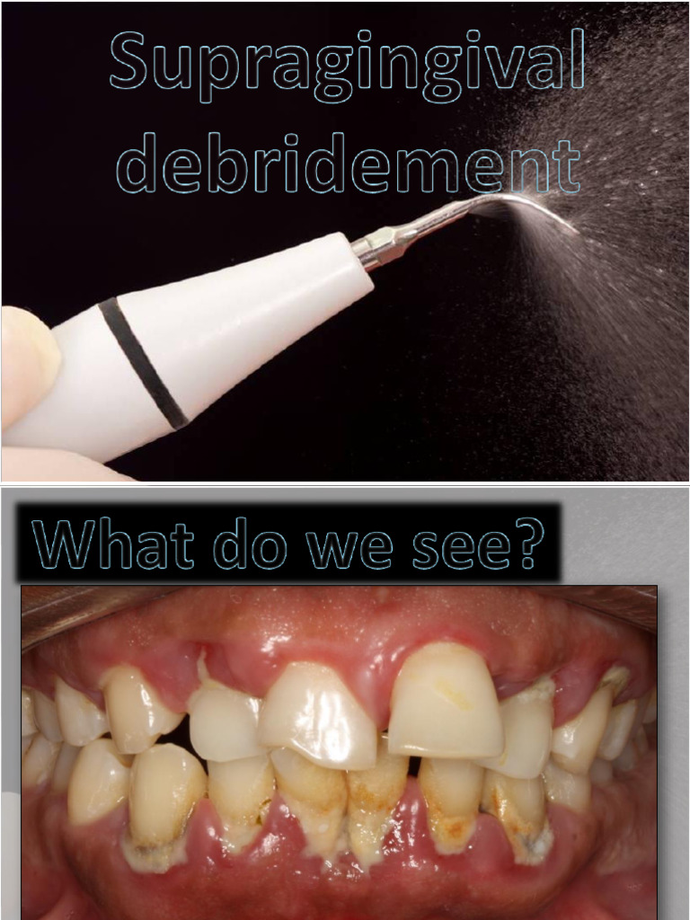 Supragingival Debridement | PDF
