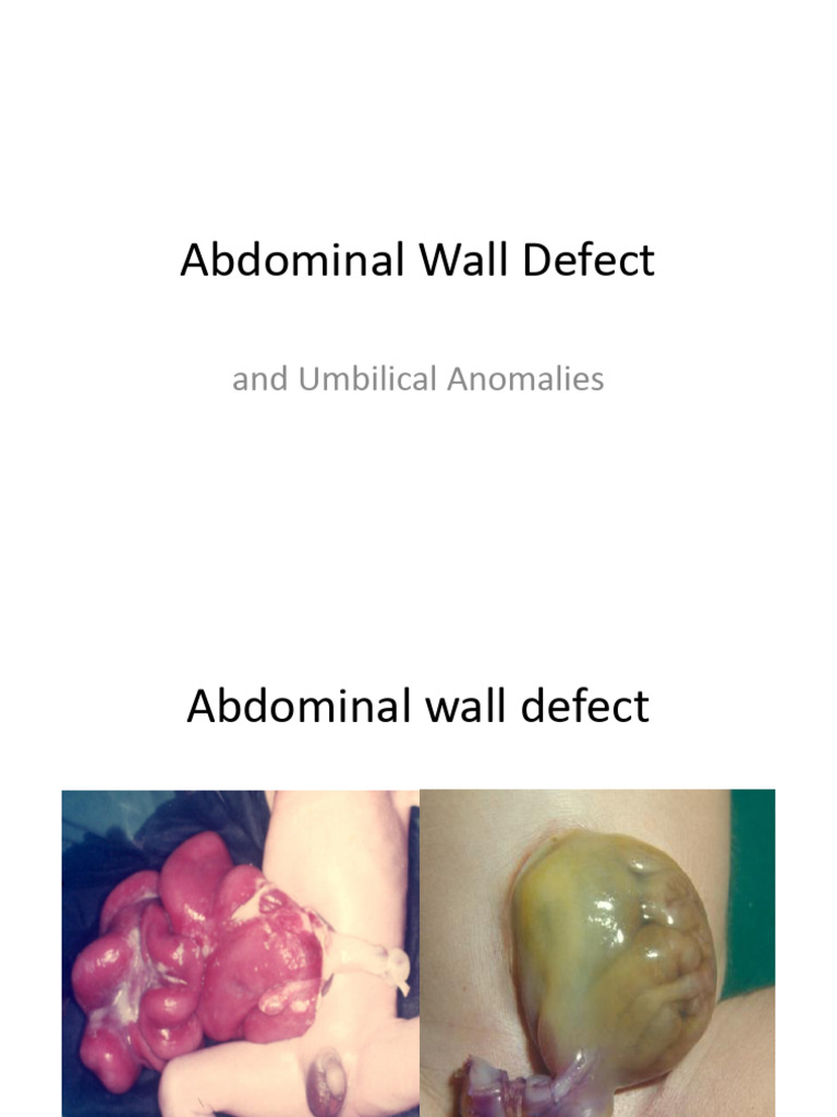 Abdominal Wall and Umbilical Defects | PDF