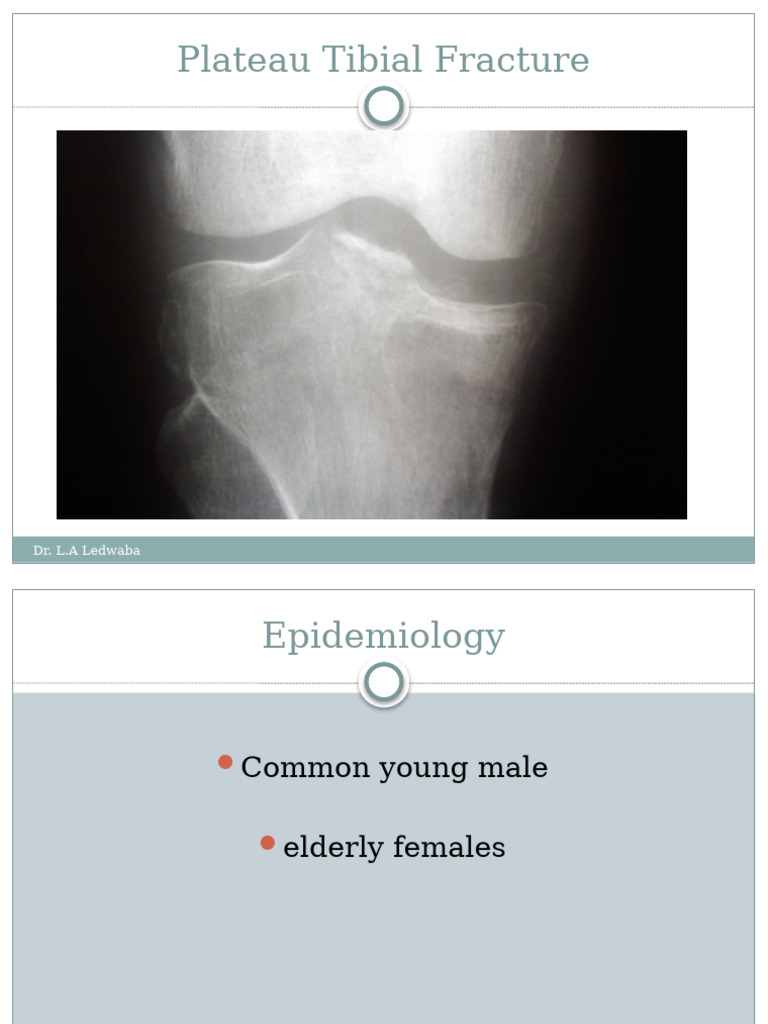 Plateau Tibial Fracture (1) | PDF | Musculoskeletal System ...