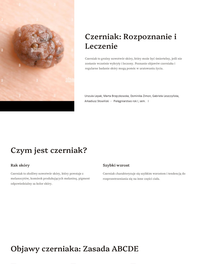 Czerniak Rozpoznanie I Leczenie | PDF