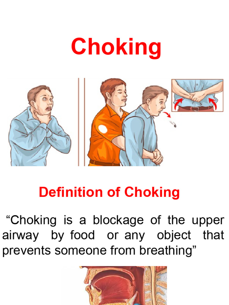 Choking +choking 3 | PDF