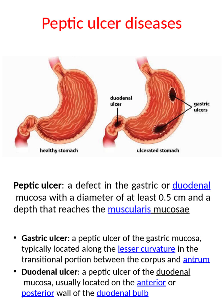 Peptic Ulcer 1 | PDF | Indigestion | Diseases And Disorders