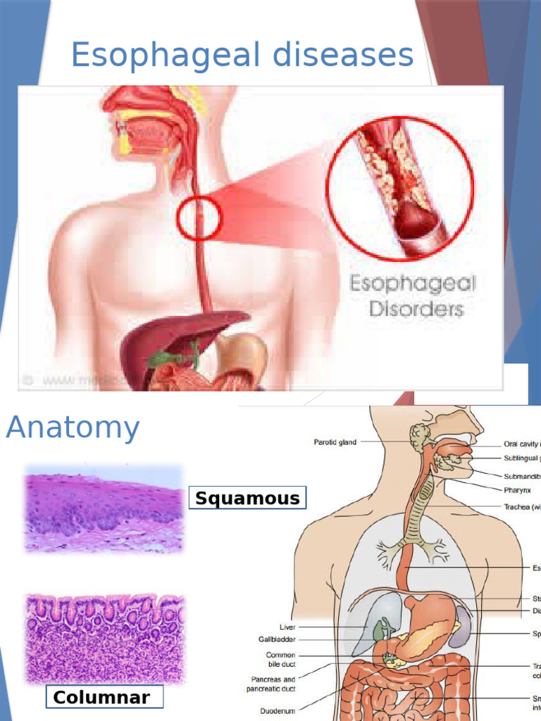 Esophageal Diseases | PDF | Gastroesophageal Reflux Disease | Esophagus