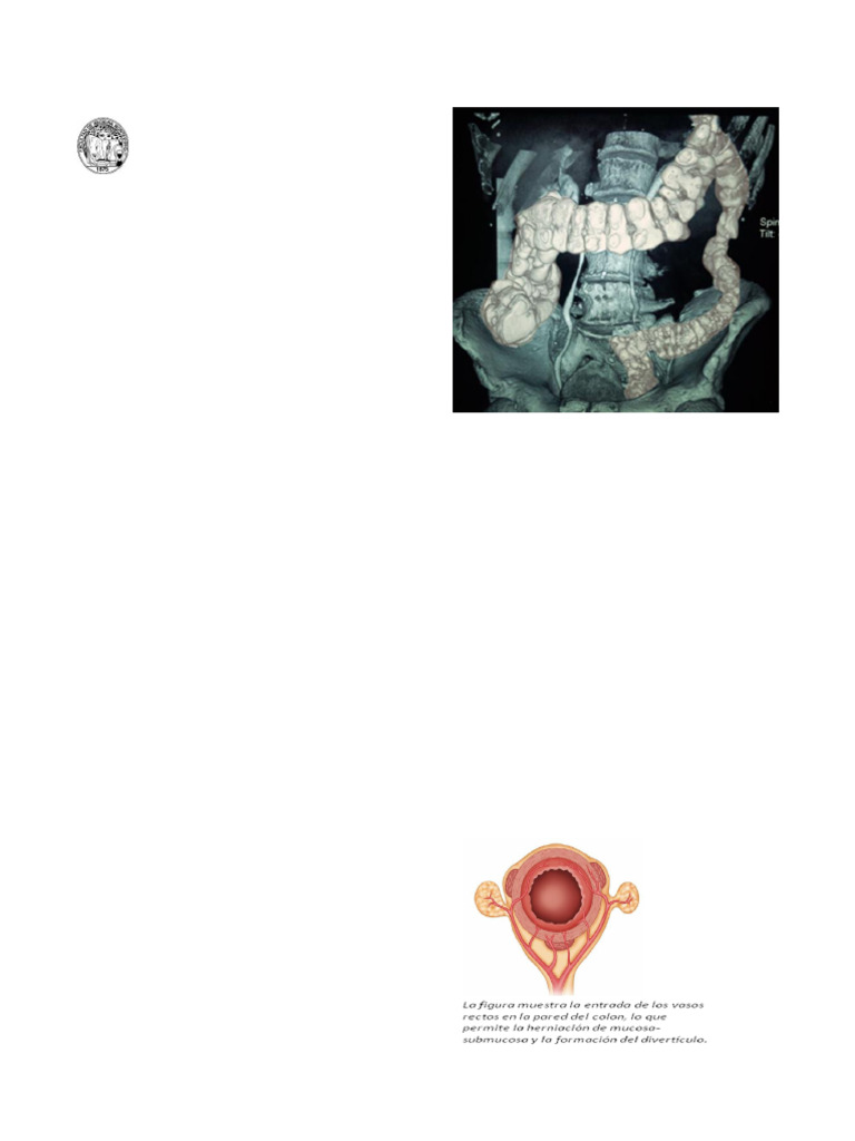 Colopatía Diverticular CQFM | PDF | Síndrome del intestino irritable ...