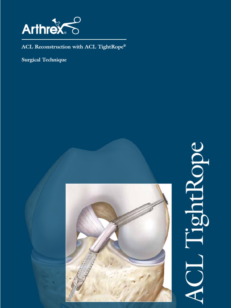 ACL TightRope Brochure | Musculoskeletal System | Medicine