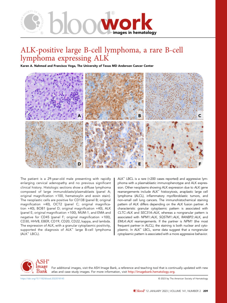 ALK positive LDCBG | PDF | Pathology | Circulatory System