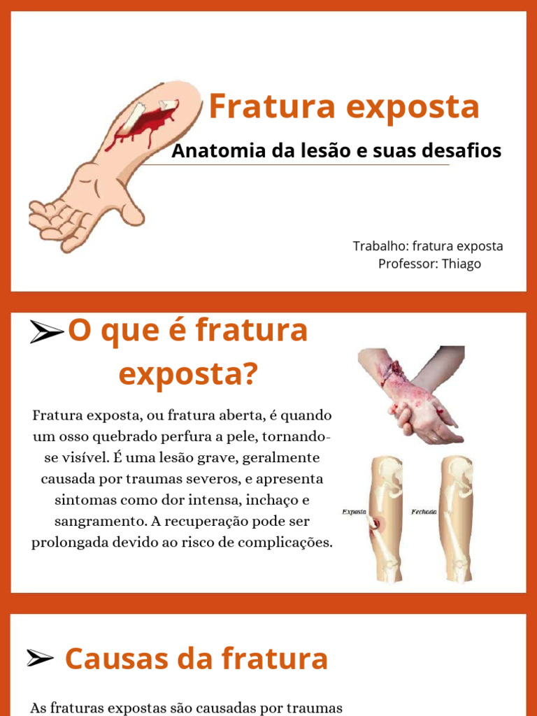 Fratura Exposta - 20241126 - 104831 - 0000 | PDF