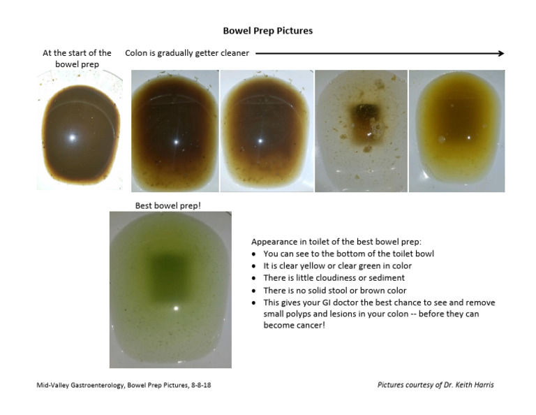 Optimal Bowel Prep Visual Guide | PDF