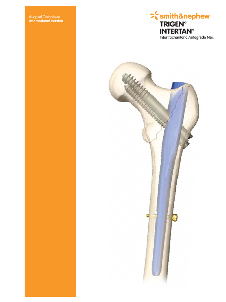 7118-1131 Trigen InterTAN | PDF | Hip | Screw