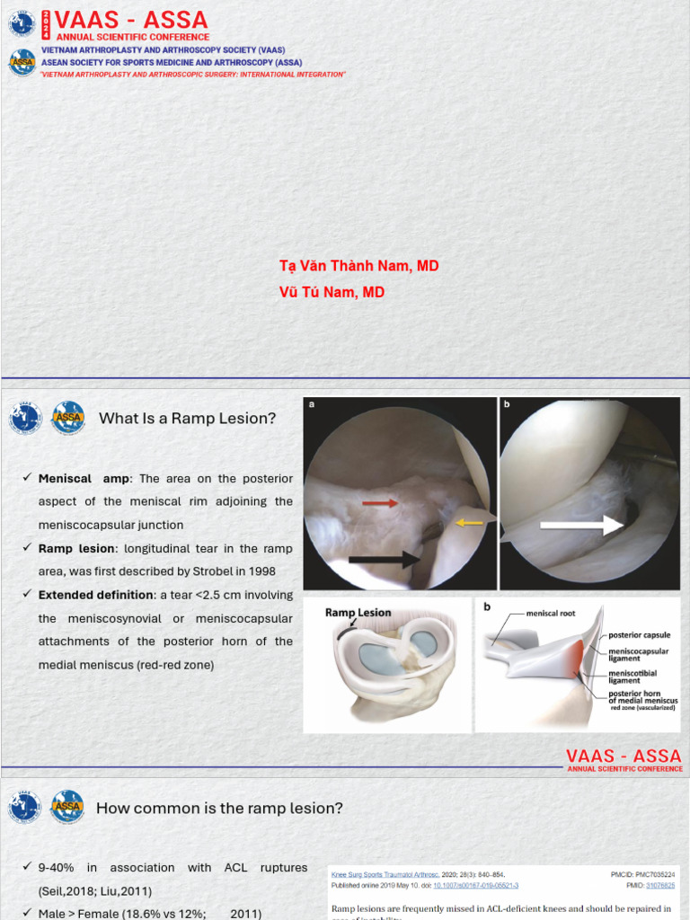Surgical Treatment of Ramp Lesions Concomitant With ACL Rupture - A ...