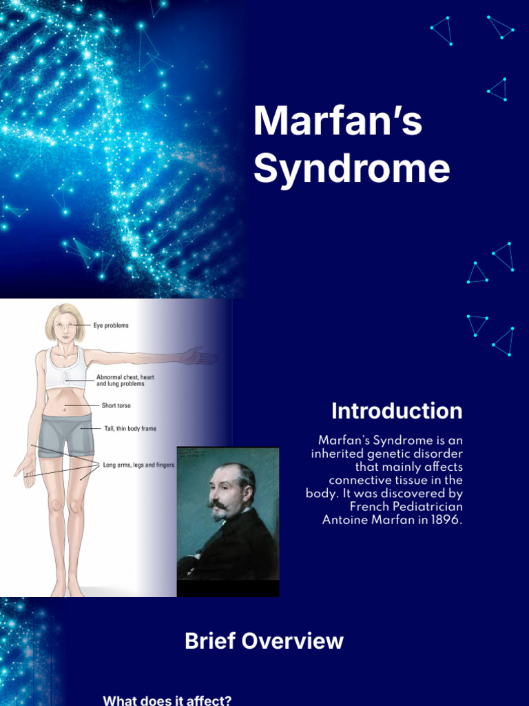 Marfan's Syndrome | PDF | Genetic Disorder | Human Diseases And Disorders