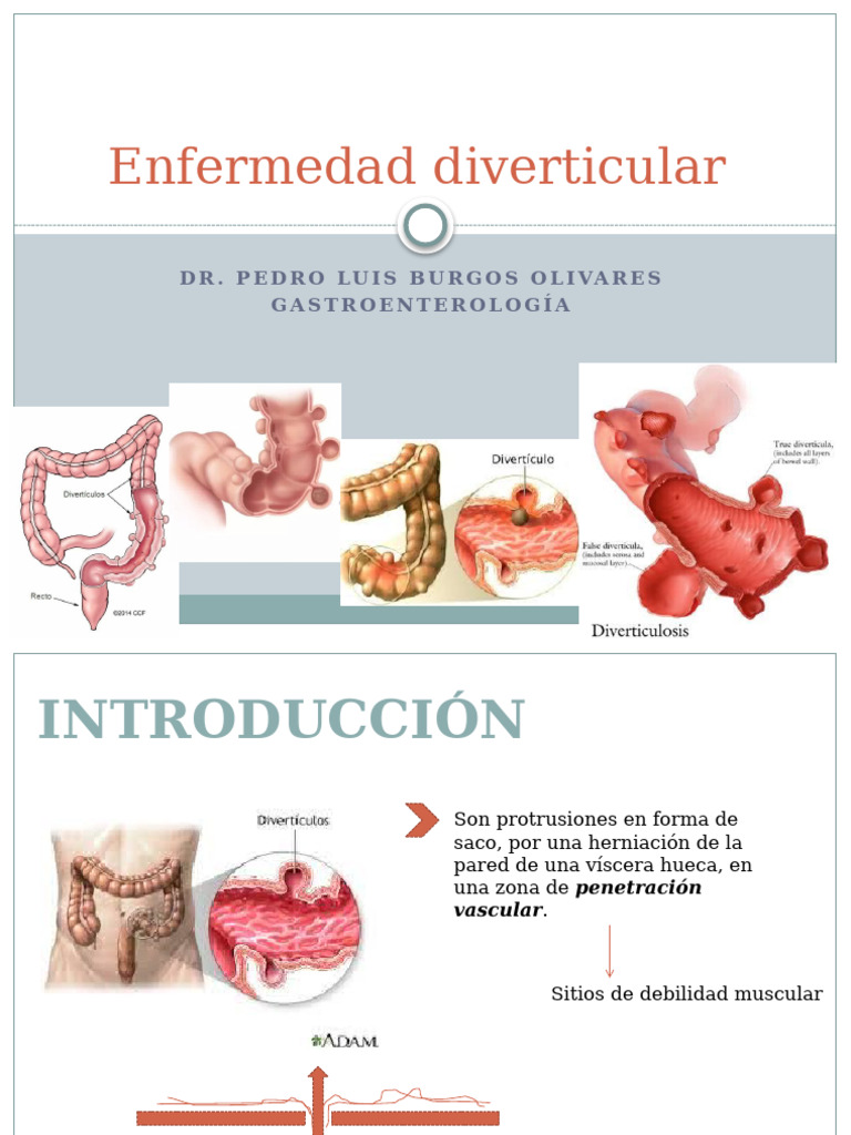 17 Enfermedad Diverticular | PDF | Enfermedades digestivas | Especialidades Medicas