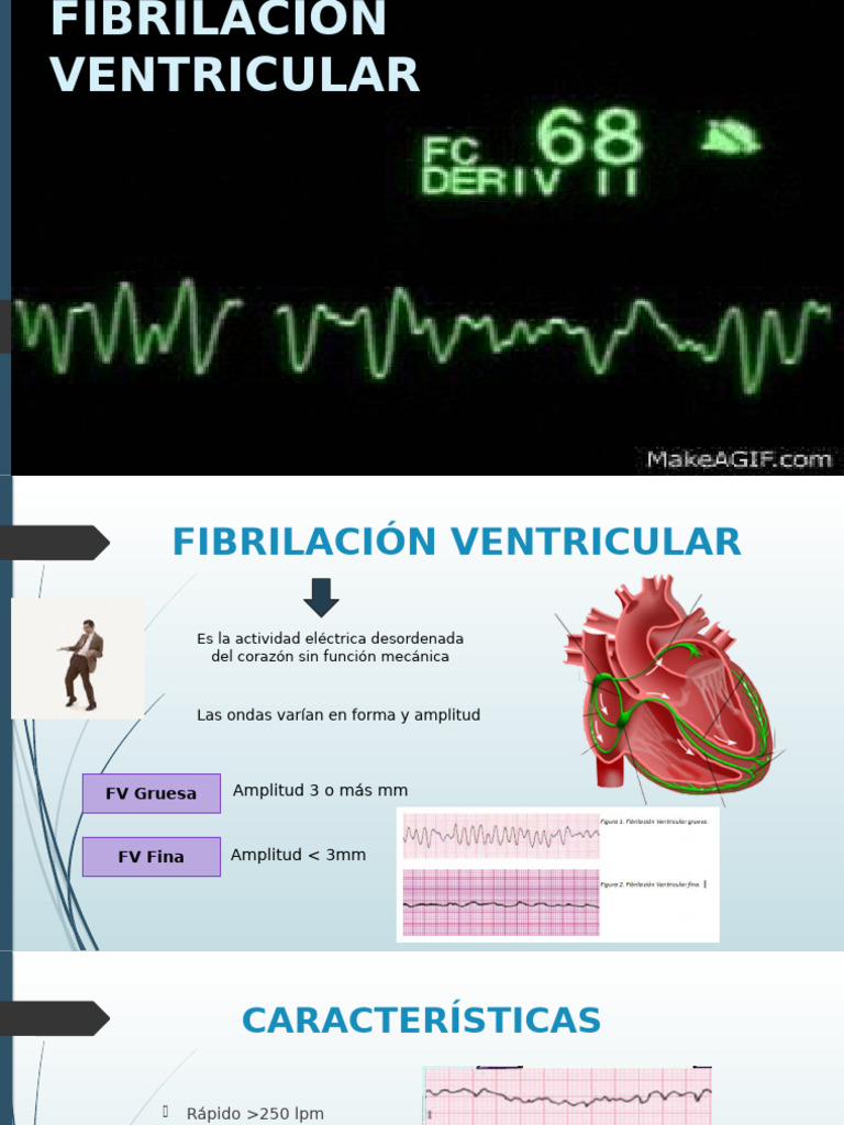 Fibrilación Ventricular: Causas y Características | PDF