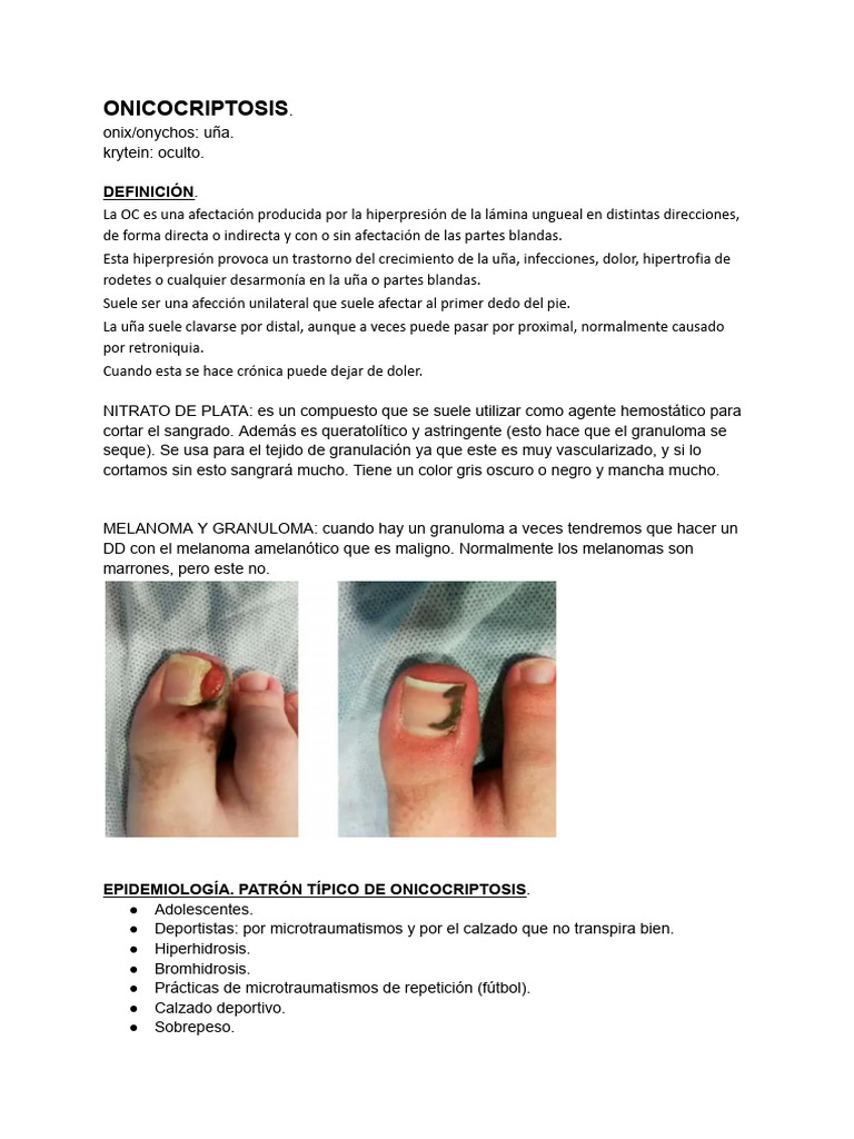 Onicocriptosis: Causas y Tratamiento | PDF | Clavo (anatomía) | Alergia