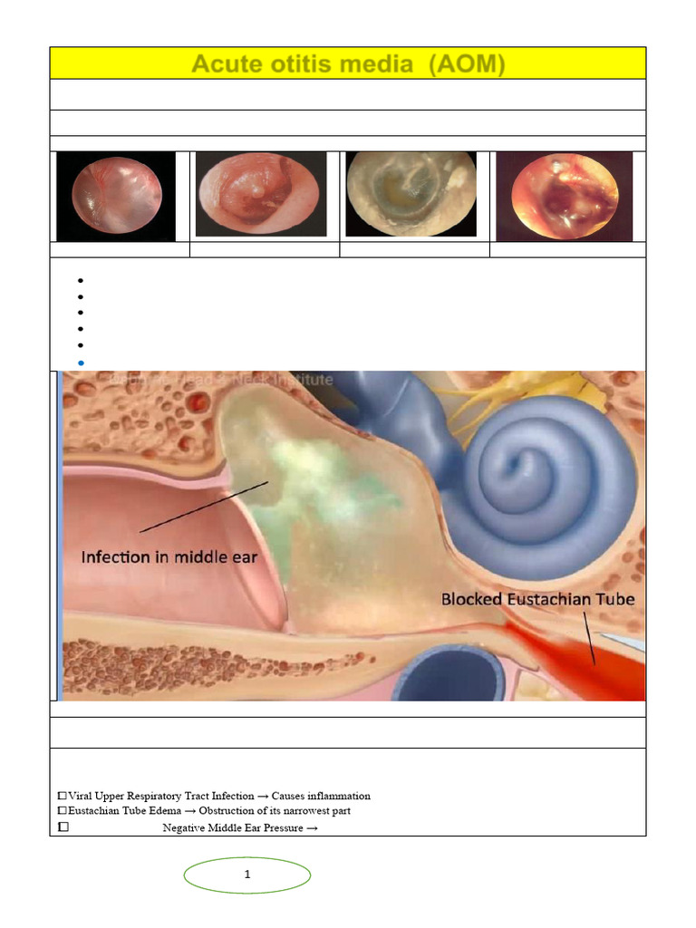 Acute Otitis Media (AOM) : Otalgia Bulging Tympanic Membrane (TM) | PDF ...