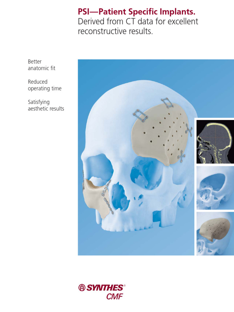 Synthes Cranial Plating Brochure | PDF | Implant (Medicine) | Strength ...