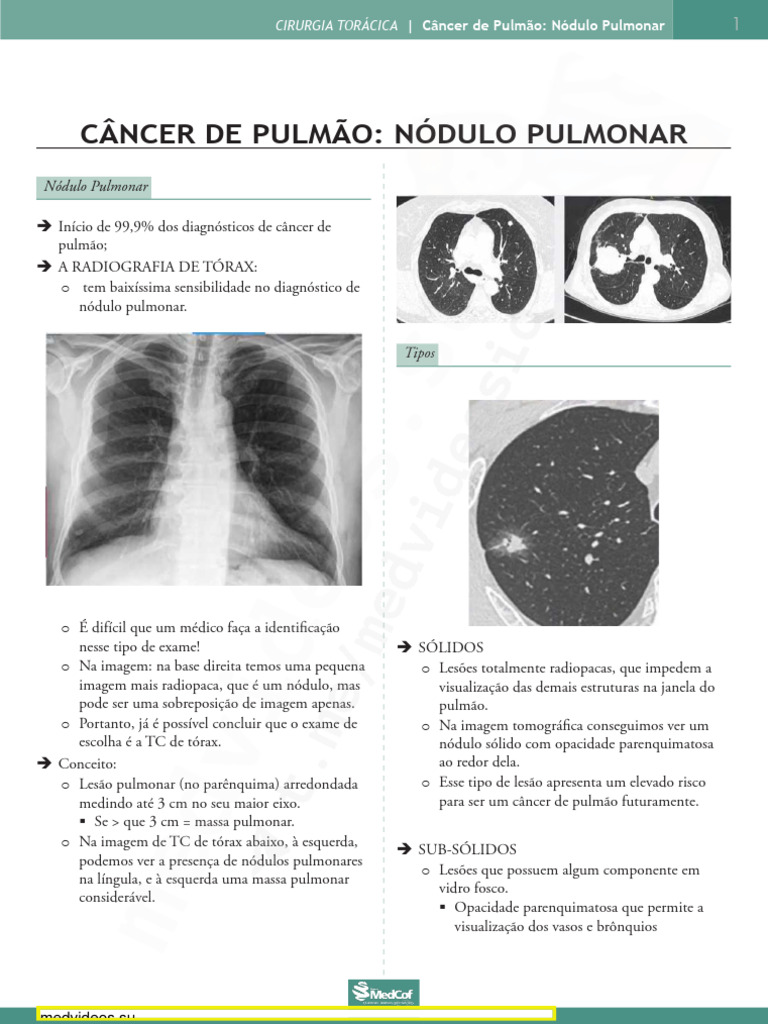 Nódulo Pulmonar e Câncer de Pulmão | PDF | Câncer de pulmão | Câncer