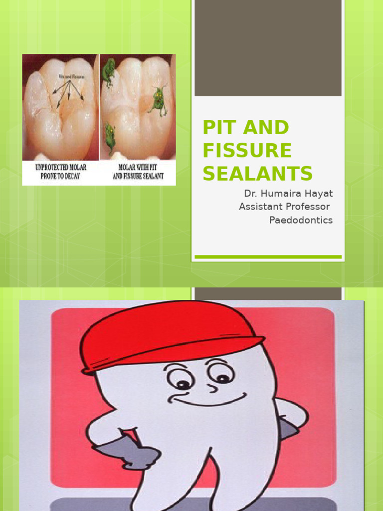 2.pit and Fissure Sealants | PDF | Tooth | Dental Anatomy