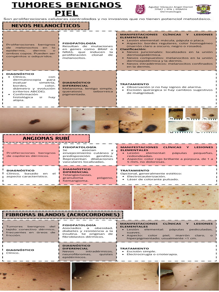 Tumores Benignos Piel Aguilar Angel Dermatología 7PM7 | PDF | Piel | Neoplasias