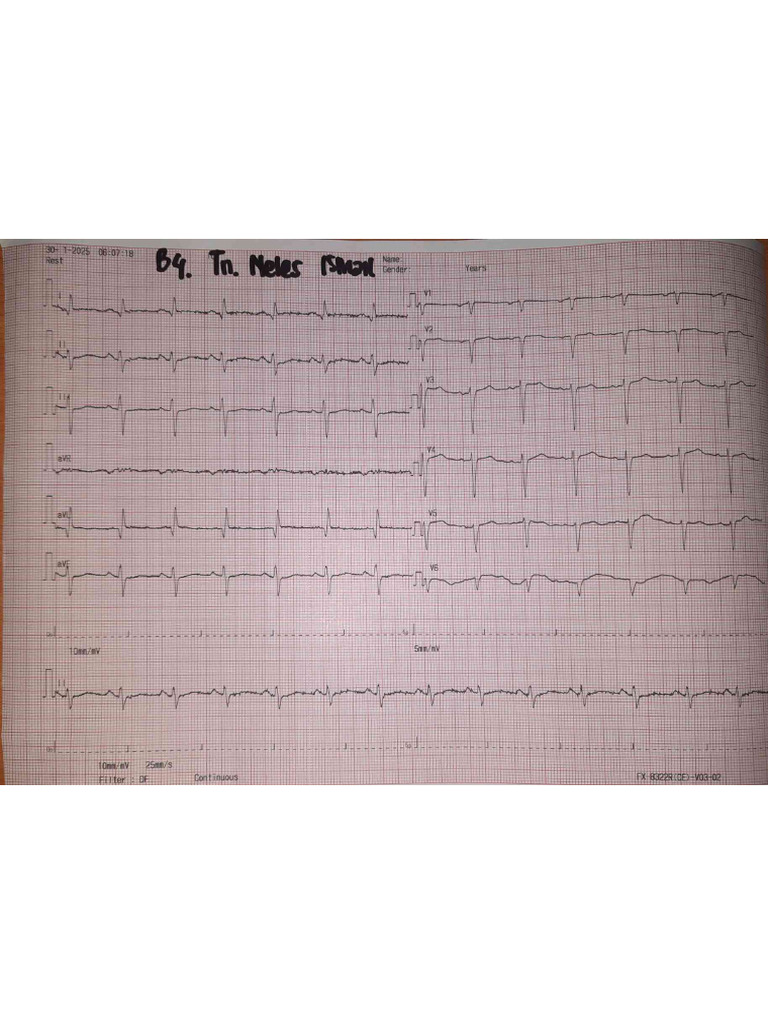 CARA MEMBACA EKG | PDF