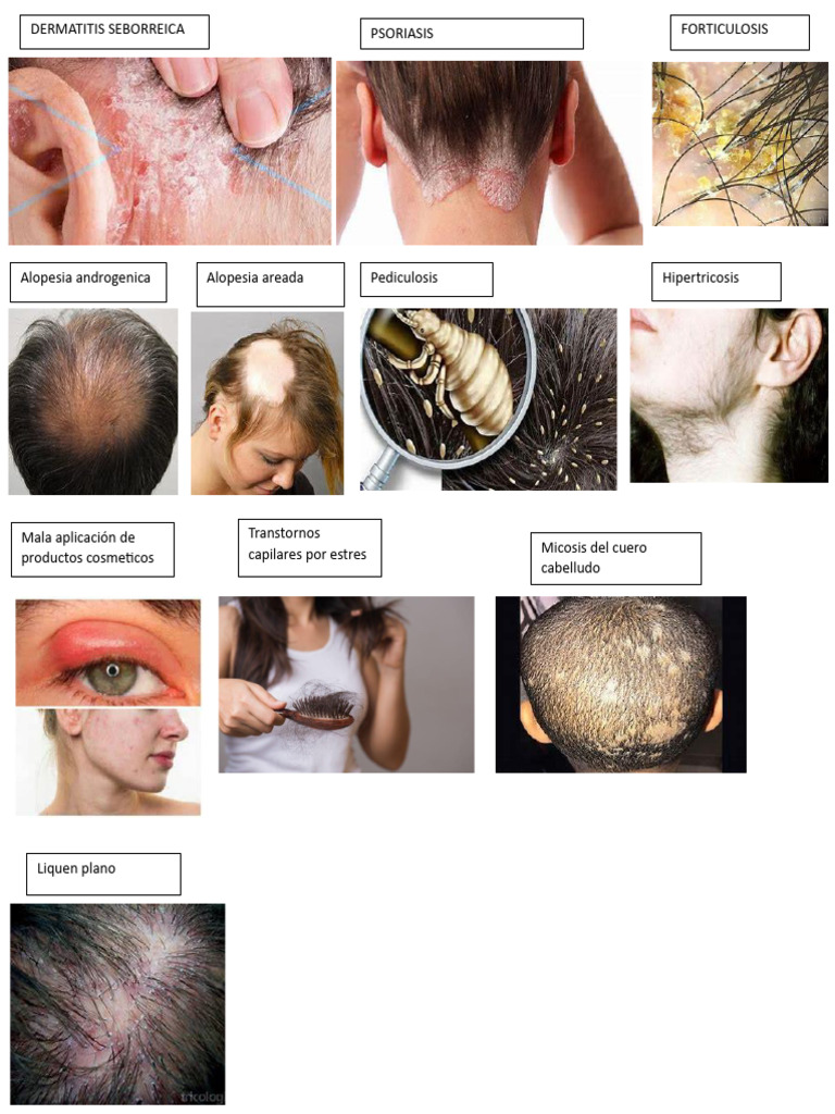 Enfermedades Del Cuero Cabelludo | PDF