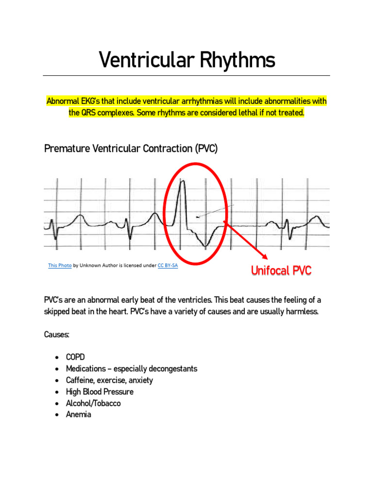4 - EKG Ventricular Rhythms | PDF
