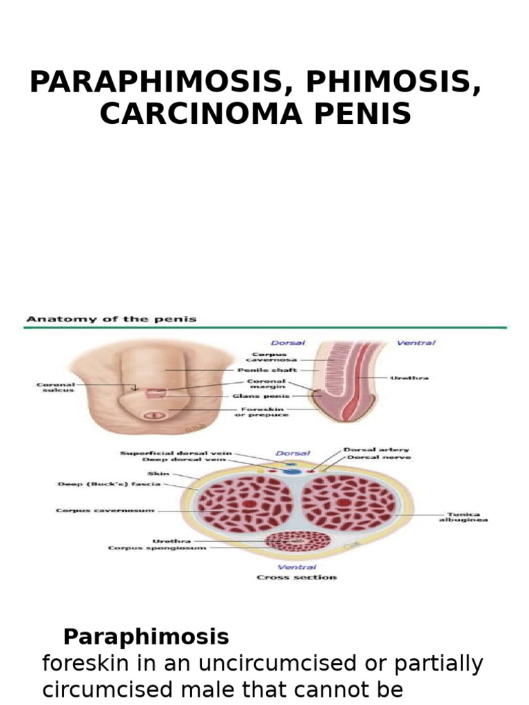 Phimosis, Paraphimosis,Carcinoma Penis | PDF | Medical Specialties ...