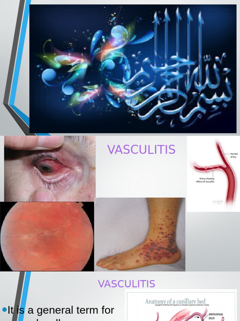 Overview of Vasculitis Types and Mechanisms | PDF | Diseases And ...