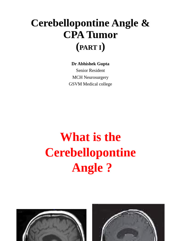 Cerebellopontine Angle Tumors Overview | PDF | Brainstem | Vertigo