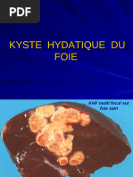 Kystes hydatiques du foie : diagnostic et traitement | PDF | Médecine ...