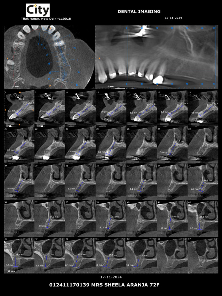 Left Maxilla Cross - Section-1 | PDF