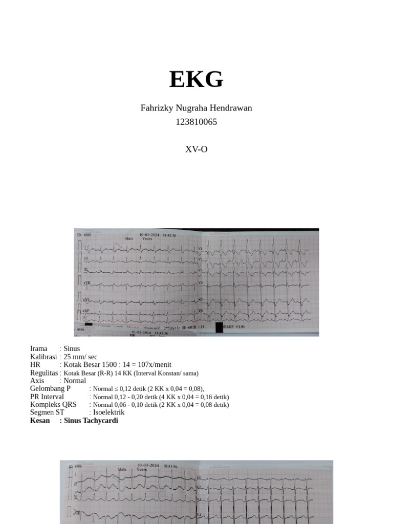 EKG - Fahrizky Nugraha Hendrawan | PDF