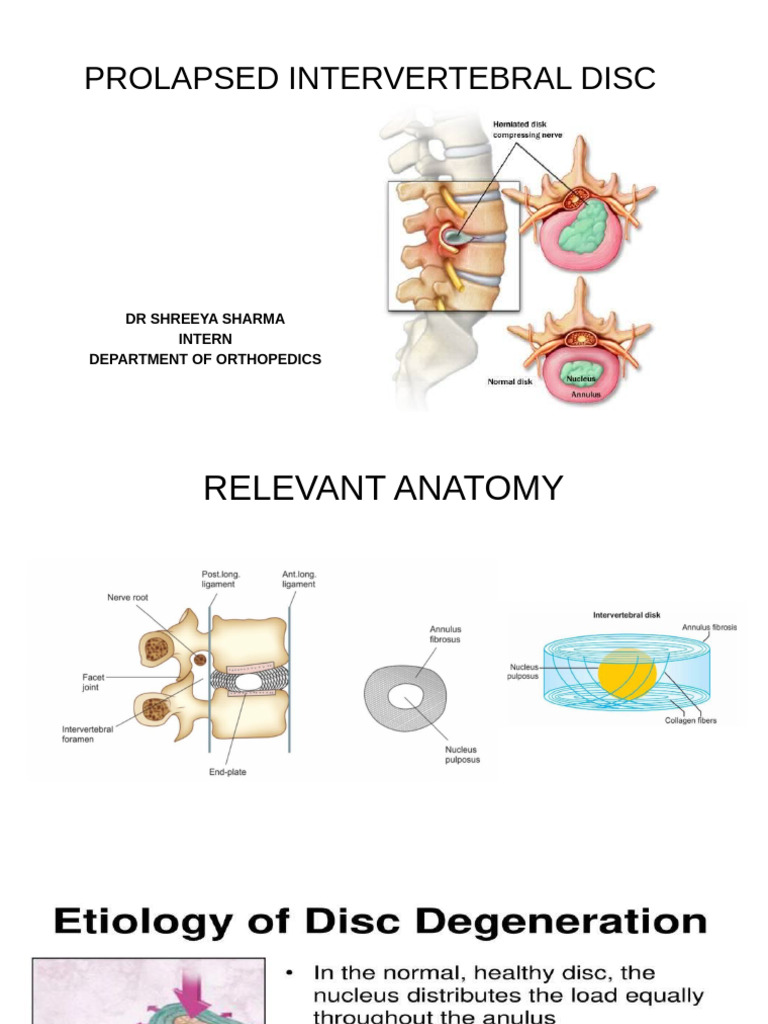 Prolapsed Intervertebral Disc_9aeb613d 807f 44a5 8f51 Feb0551b1067 ...