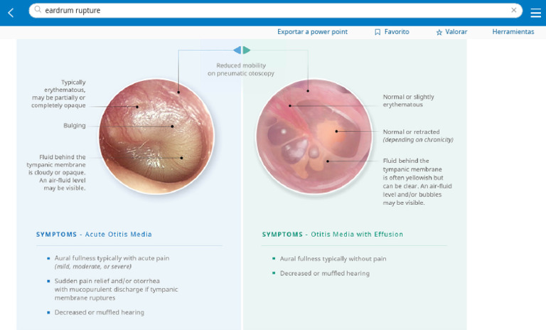 Acute Otitis Media Vs Otitis Media With Effusion - UpToDate | PDF
