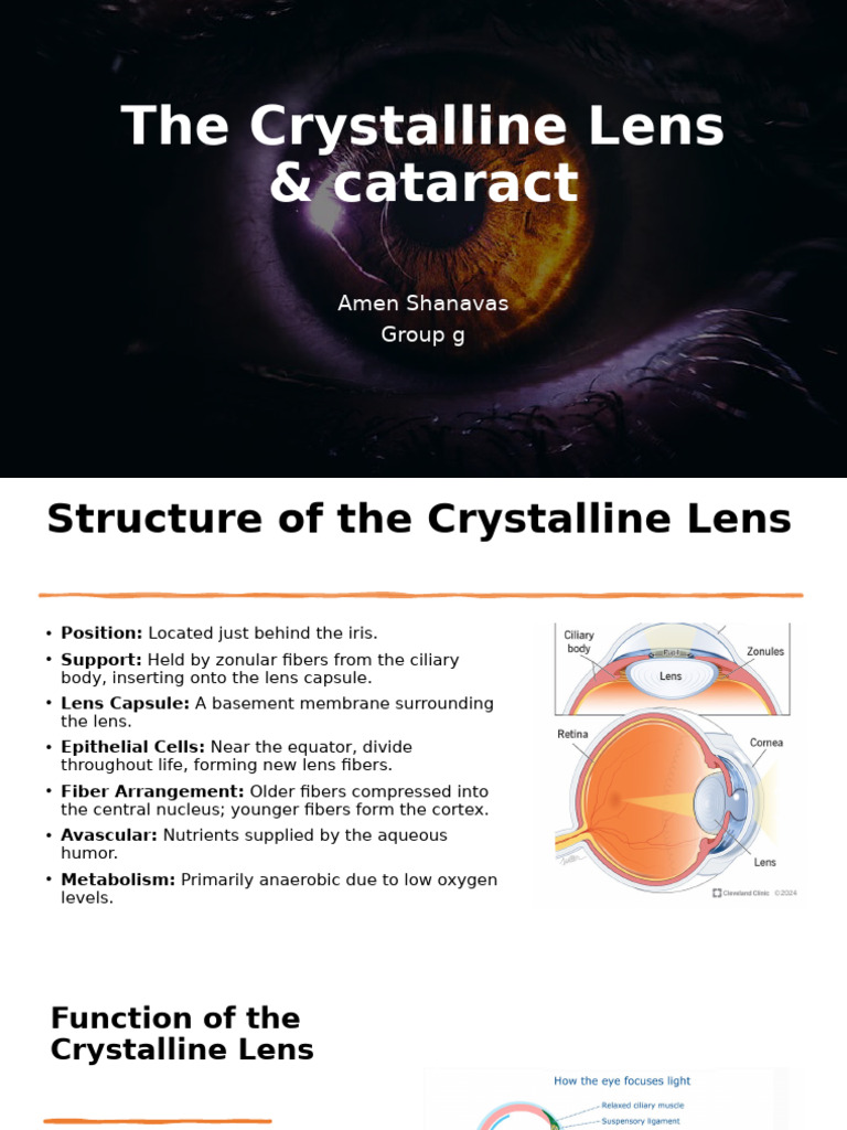 Understanding Crystalline Cataracts | PDF | Cataract | Visual System
