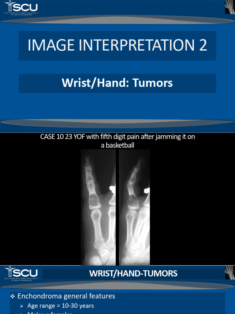 Wrist Hand Tumor | PDF