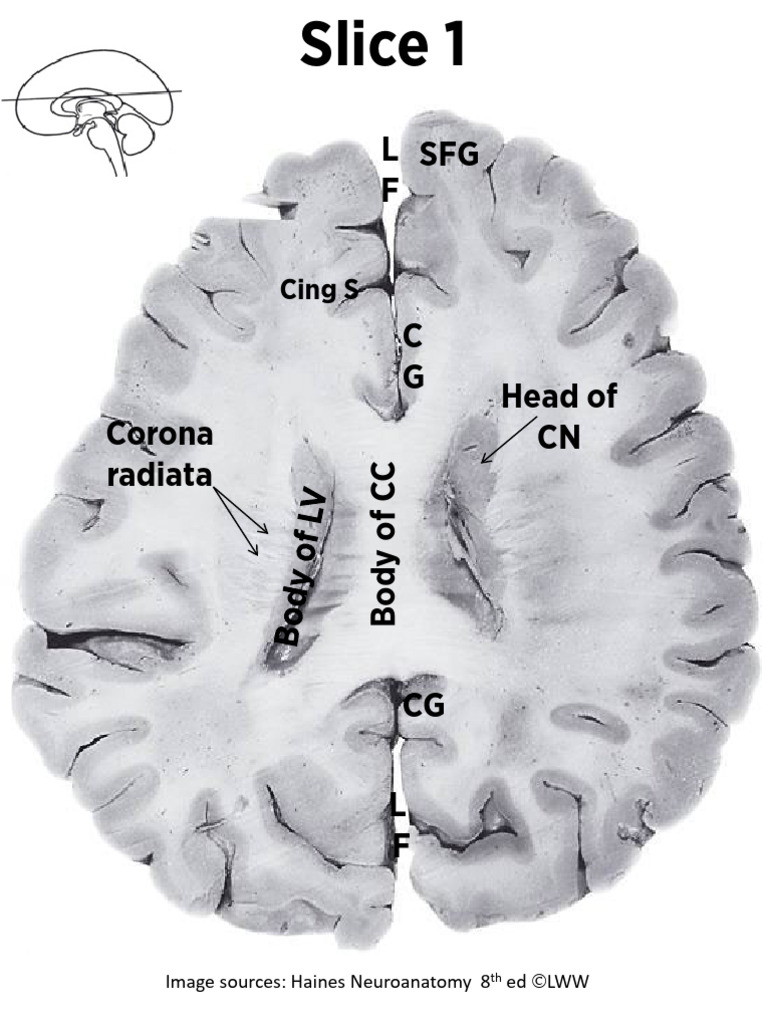 HSSS HS Brain Slices Labelled | PDF | Corpus Callosum | Nervous System