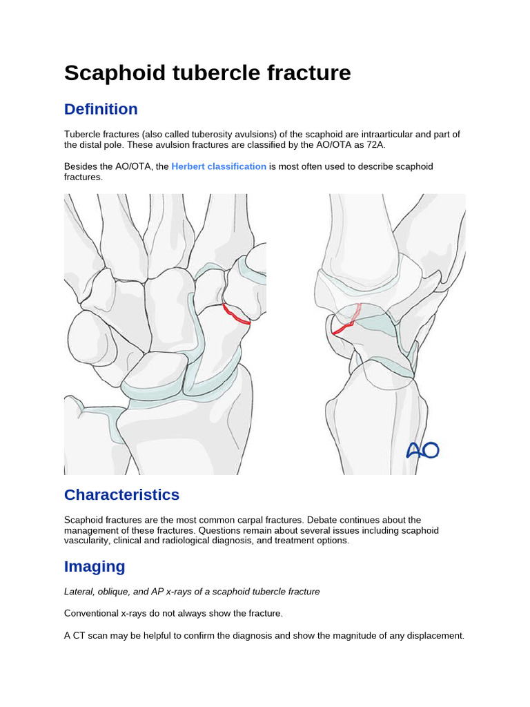 scaphoid-tubercle-fracture-overview-pdf