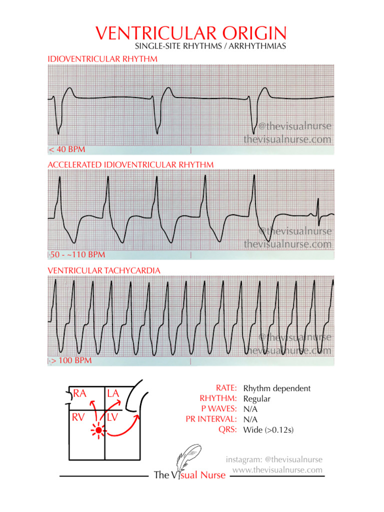 Understanding Ventricular Rhythms | PDF