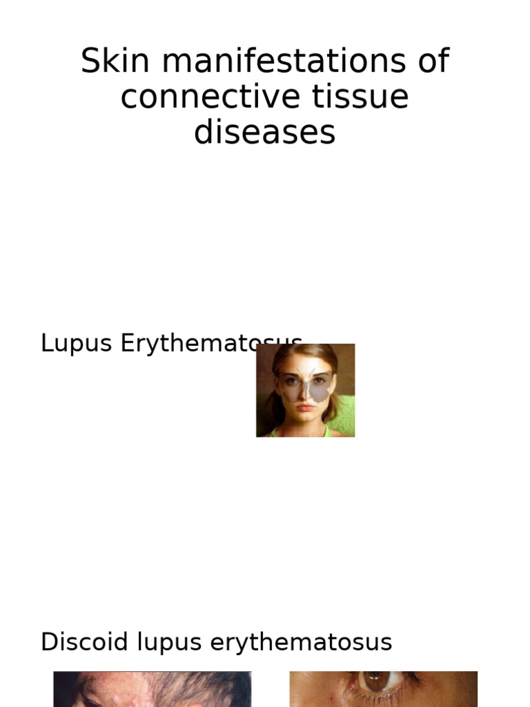 Skin Manifestations of Connective Tissue Diseases (1) | PDF