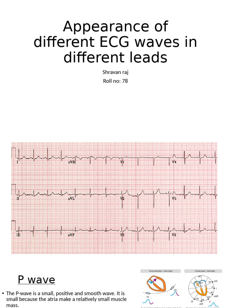 ECG Waveforms in Different Leads | PDF | Electrocardiography | Cardiology