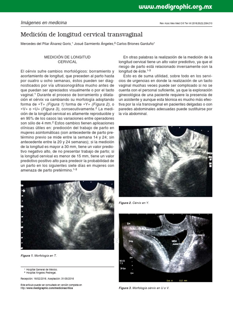 Medicion de Longitud Cervical Medigraphic | PDF | Parto | Maternidad