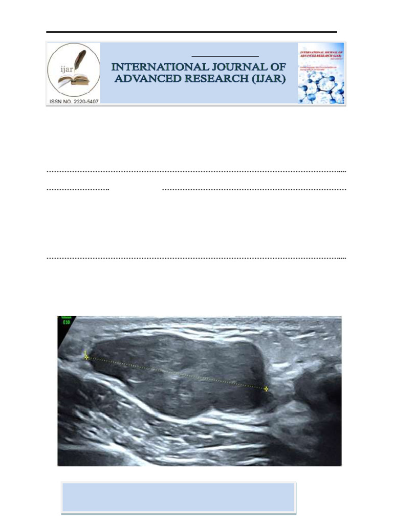 Pseudoangiomatous Stromal Hyperplasia (Pash) of The Breast: A Report of Four Cases | PDF ...